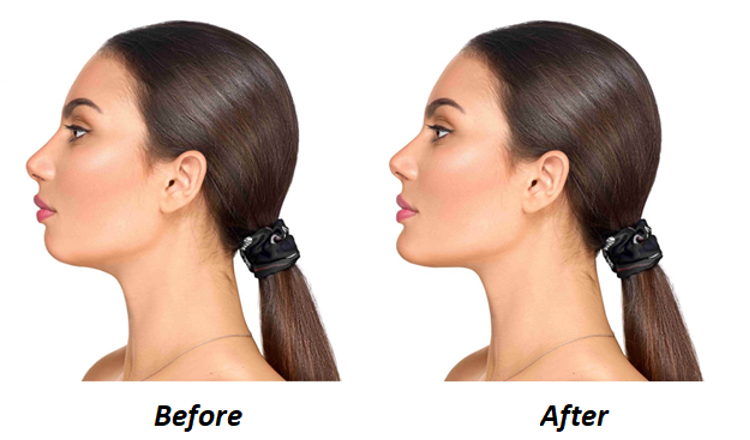 Tạo hình cằm v-line với cấy mỡ