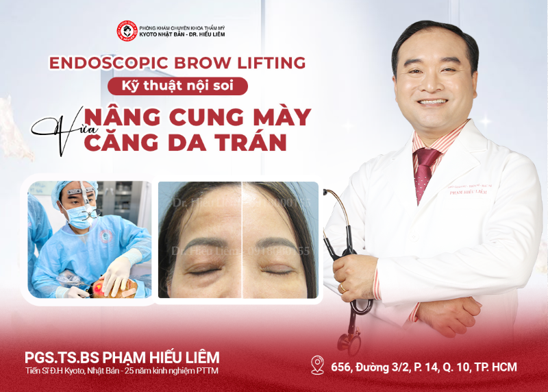 Endoscopic Brow Lifting - Kỹ thuật nội soi giúp vừa nâng cung mày vừa ...